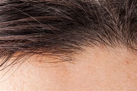 How Much Does A Hair Transplant Cost Palms Wellington Plastic