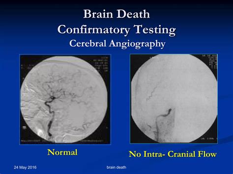 Brain Death Presentation Pptx