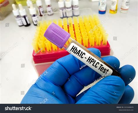 Blood Sample Hba C Hplc Test Diabetes Stock Photo Shutterstock