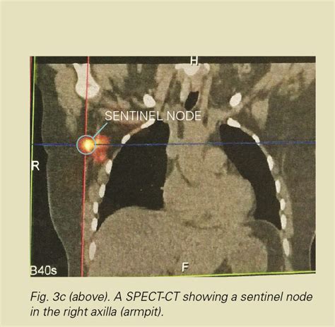 Sentinel Node Biopsy Westmead Breast Cancer Institute