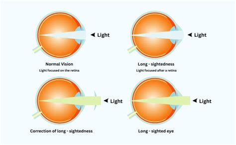 How Do Contact Lenses Work Eyestyle Blog