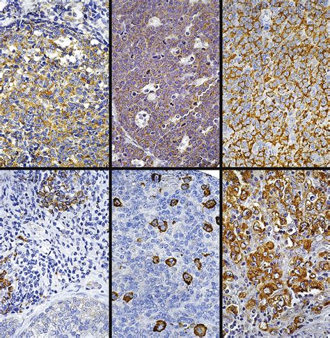 Expression Of Vickz Protein In Lymphomas Vickz Staining In Typical