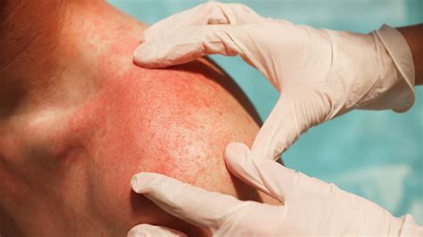 Enfermedades Alérgicas De La Piel Precios En Turquía 2025 Dr