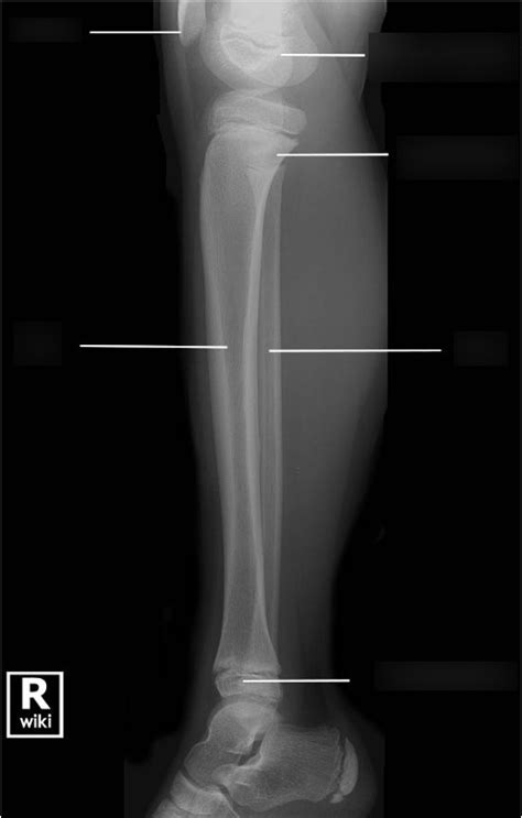 Lateral Tibfib Labelled Diagram Quizlet