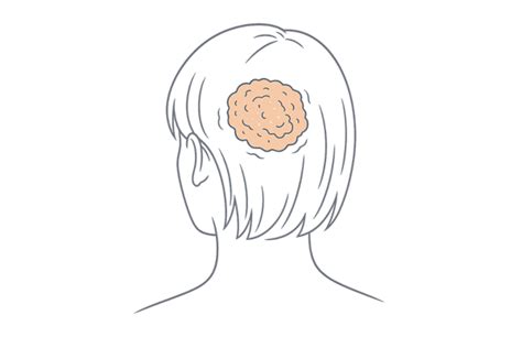 真菌性脱毛症・しらくも（頭部白癬）の症状とセルフチェック法 女性薄毛治療のいろは Agaメディカルケアクリニック