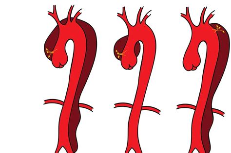 Aortic Dissection Healthcare Professionals