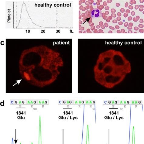 Figure1 A Platelet Histograms From The Patient And A Healthy Control Download Scientific