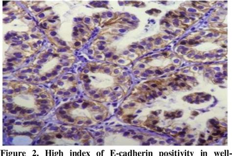 Figure 1 From Association Of E Cadherin Expression With Histological