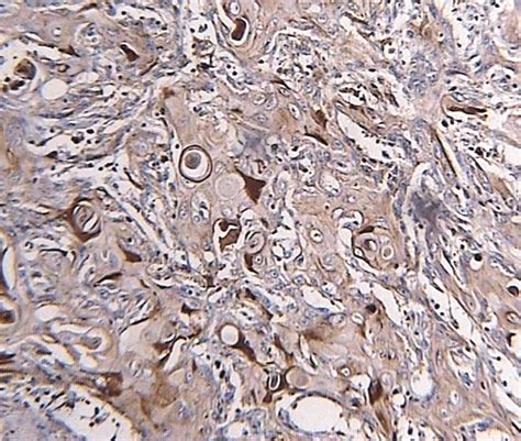 E Cadherin Expression In Oscc Grade Ii And Advanced Stage 100×