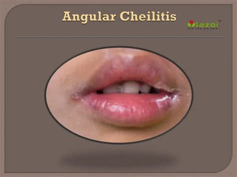 Ppt Cracked Corners Of Mouth Cheilitis Angular Cheilitis Remedy Ppt Cracked Corners Of Mouth Cheilitis Angular Cheilitis Remedy