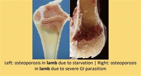 Metabolic Skeletal Diseases Flashcards Quizlet