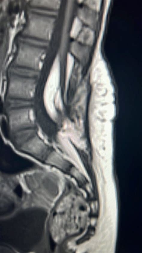 Tip Of The Day 💡 What Makes A Lipoma Really Complex When Fatty