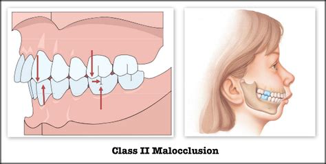 Angles Classification Of Malocclusion Dentodontics