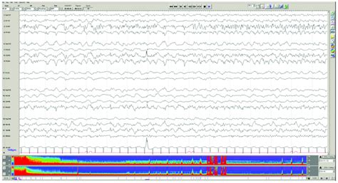 Status Epilepticus In A 7 Year Old Male With No Neurologic