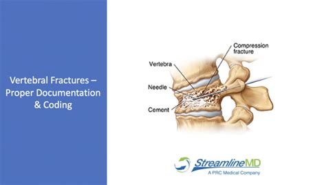 Vertebral Fractures Proper Documentation And Coding Streamlinemd