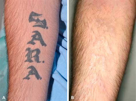 Laser Tattoo Removal Strategies Part Ii A Review Of The Methods