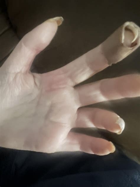 Dd R Dupuytrendisease