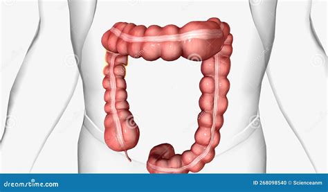 Chronic Idiopathic Constipation Is A Gastrointestinal Condition