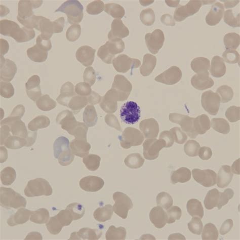 High Absolute Basophil Count Is A Powerful Independent Predictor Of