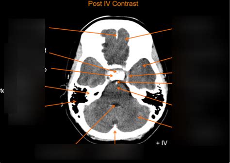 Diagram Of Ct Head 2 Quizlet