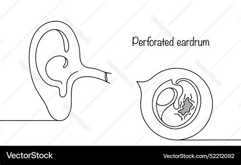 Perforated Eardrum Royalty Free Vector Image Vectorstock