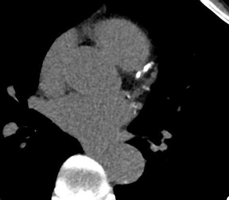 081h Ct Heavy Calcification Lung Cancer Screening Discrepant Cath The Common Vein
