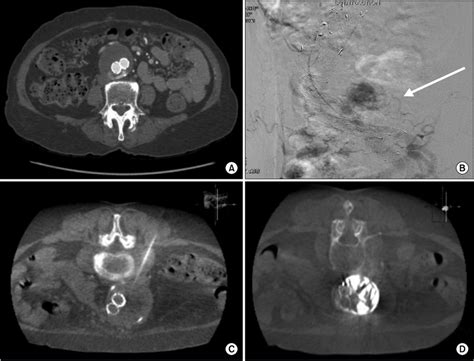 A Type Ii Endoleak B Transarterial Approach Was Failed Due To
