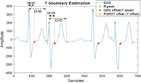 Figure 8 From An Automatic R And T Peak Detection Method Based On The