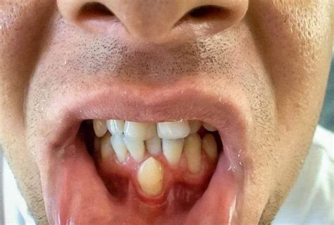 Are Supernumerary Teeth Hereditary