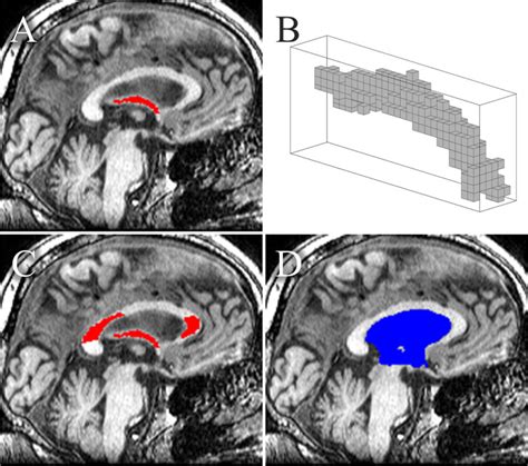 a sagittal slice of a fornix segmentation with t1w background image