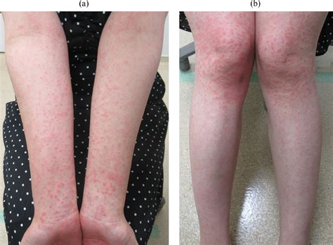 Ebv Rash After Amoxicillin