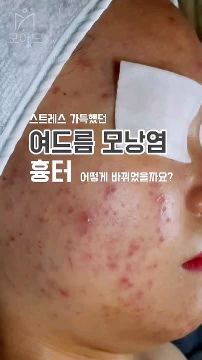 스트레스 가득했던 여드름 모낭염 흉터 개선 건대 피부관리 모아드 Youtube