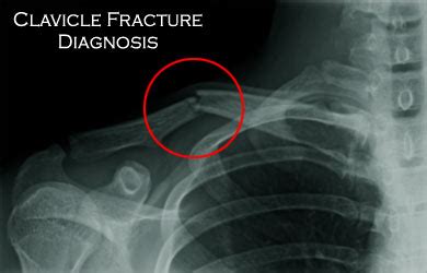 Clavicle Fracture Broken Collarbone Symptoms Diagnosis Treatment