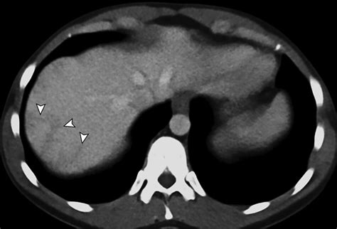 Hepatic Sinusoidal Disorders Radiographics