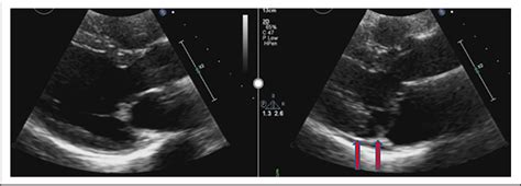Figure 1 From Echocardiographic Assessment Of Mitral Annular Disjunction With Cross Correlation