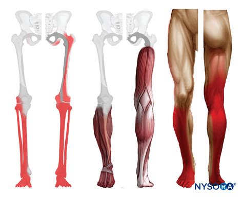 Ultrasound Guided Sciatic Nerve Block Nysora