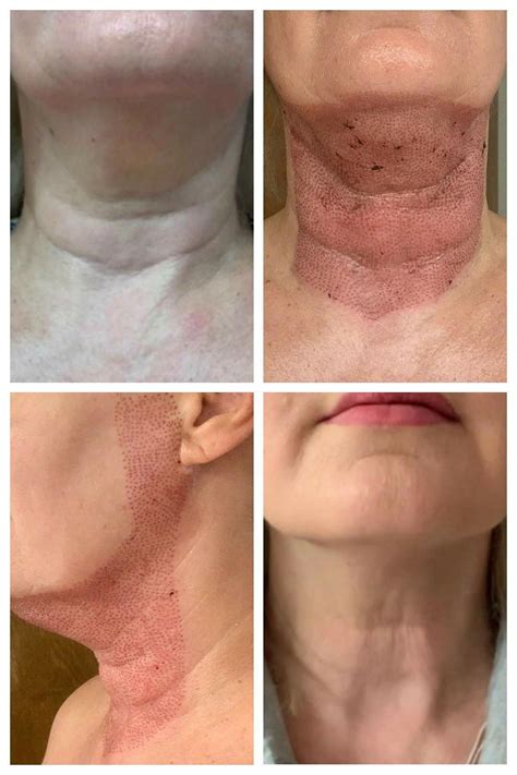 Methods Of Unwanted Hair Removal Artofit