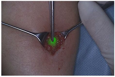 Sentinel Node Detected By Near Infrared Light Download Scientific Diagram
