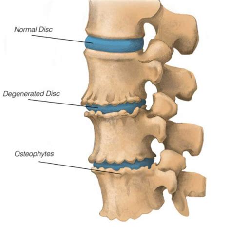 The Best Treatment For Arthritis In The Lower Back — Solving Pain With