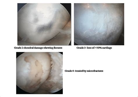 Grading Of Severity Of Chondral Damage On The Basis Of Outerbridge