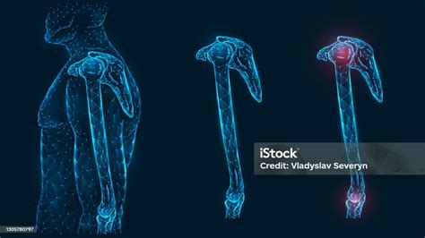인간 해부학 모델 어깨와 팔꿈치 관절의 통증 부상 및 염증은 파란색 배경에서 다각형 그림을 봅니다 건강하고 아픈 관절 어깨에 대한 스톡 벡터 아트 및 기타 이미지 Istock