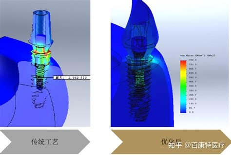 百康特种植体怎么样？ 知乎