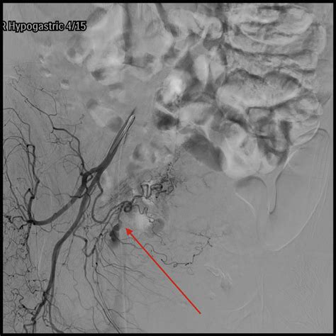 Selective Catheterization Of The Right Uterine Artery With Subsequent Download Scientific