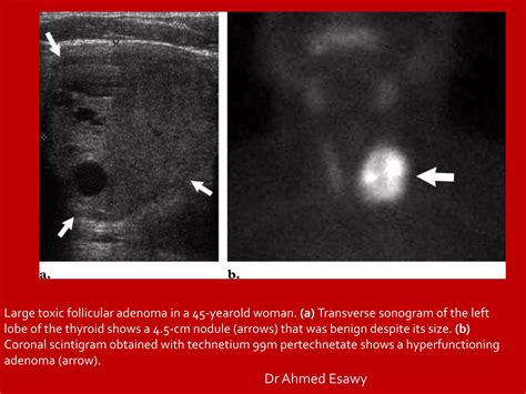 Tirads Thyroid Nodule Imaging Reporting And Data System Dr Ahmed