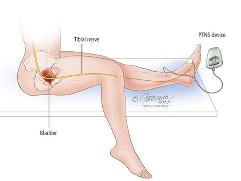 Neurogenic Bladder Symptoms Diagnosis And Treatment Urology Care