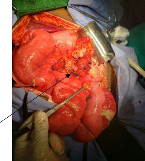 Left Side Perforated Appendicitis With Intestinal Non Rotation A Case