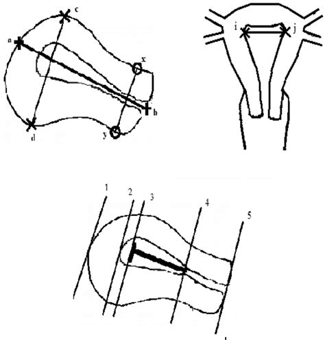 A Schematic Illustration Of Ultrasonographic Uterine Measurements Download Scientific Diagram