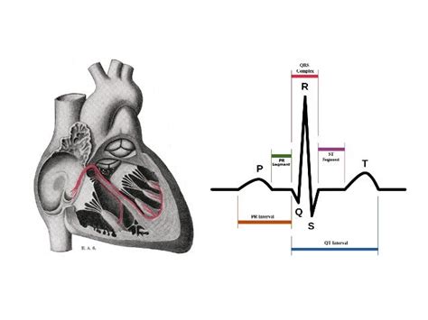 Ecg Lecture Sinus Arrest Sinoatrial Exit Block Av Block And Escape…