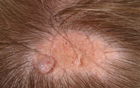 Seborrheic Nevus