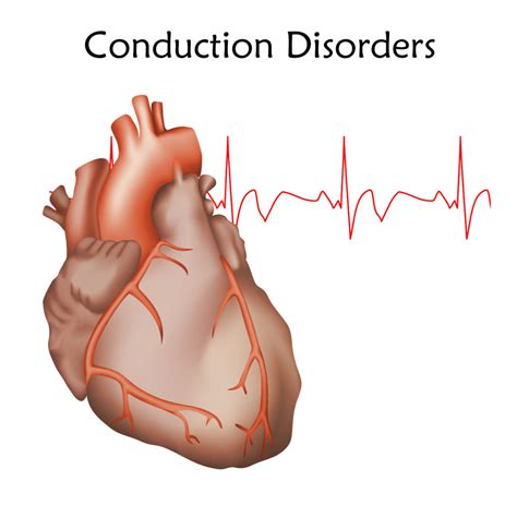 Conduction Disorders Virginia Arrhythmia Consultants